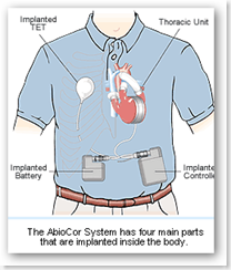 Hopkins Hospital to begin implanting AbioCor replacement hearts ...